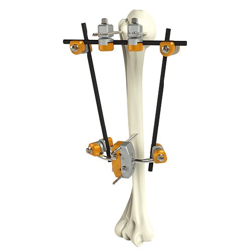 Knee Joint External Fixator - Orthopromed Inc.