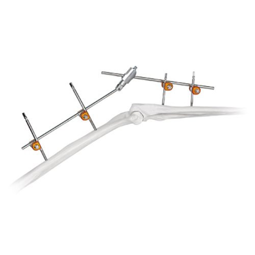 Ulna & Radius External Fixator - Orthopromed Inc. Medical