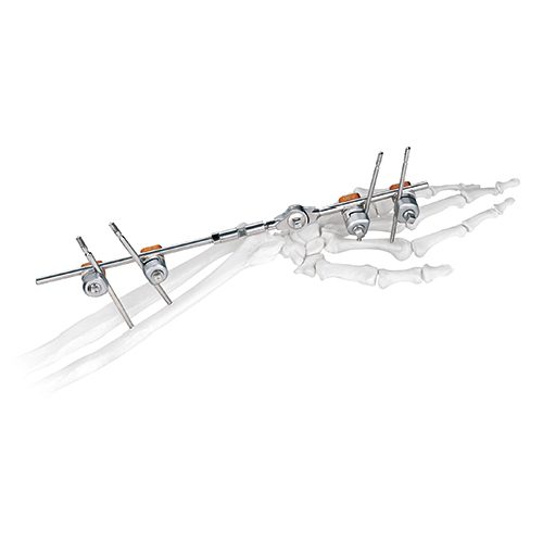 Proximal Femur External Fixator - Orthopromed Inc.