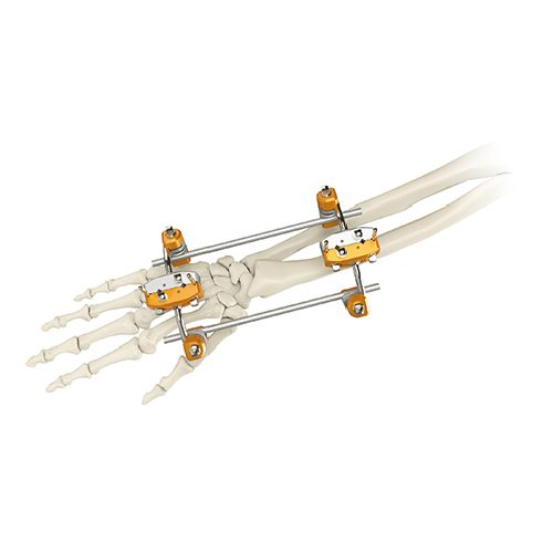 Elbow Joint External Fixator - Orthopromed Inc.
