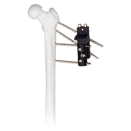 Mini Fragment External Fixator (Finger and Palm) - Orthopromed Inc.