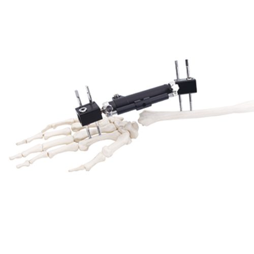 Elbow Fragment External Fixator - Orthopromed Inc. Medical