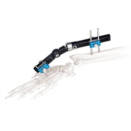 Hip Joint Traction External Fixator - Orthopromed Inc.