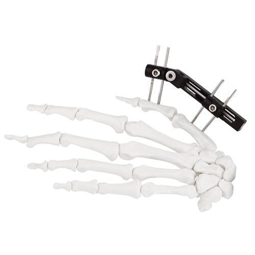 Mini Fragment External Fixator (Finger and Palm) - Orthopromed Inc. Medical