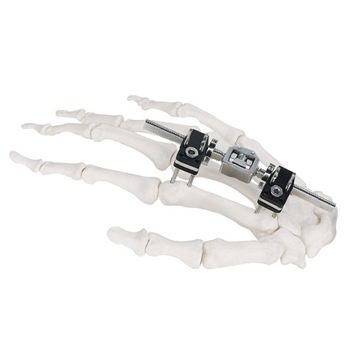 Wrist Joints External Fixator - Orthopromed Inc. Medical